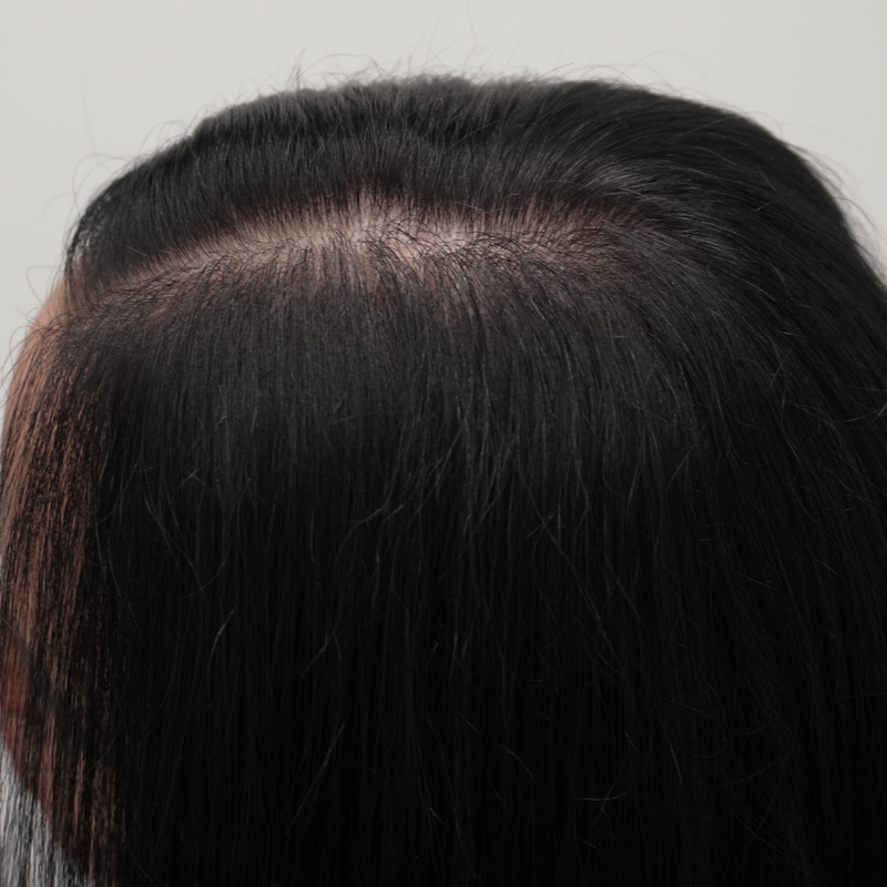 Elevai Root Renewal System™ | Exosome Regenerative Kit for Hair Loss – Elevai Skincare